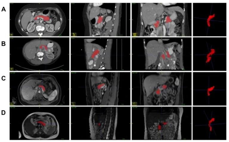 Deep Learning Algorithms for Pancreas Segmentation from Radiology Scans ...